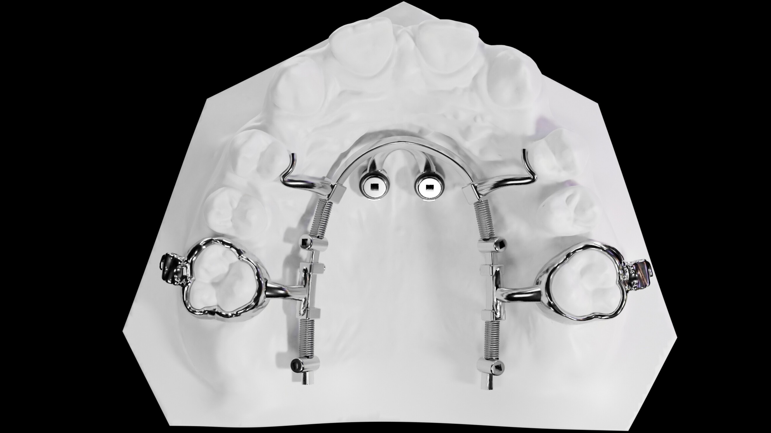 Aligner therapy: mini-implant-borne sliders and expanders