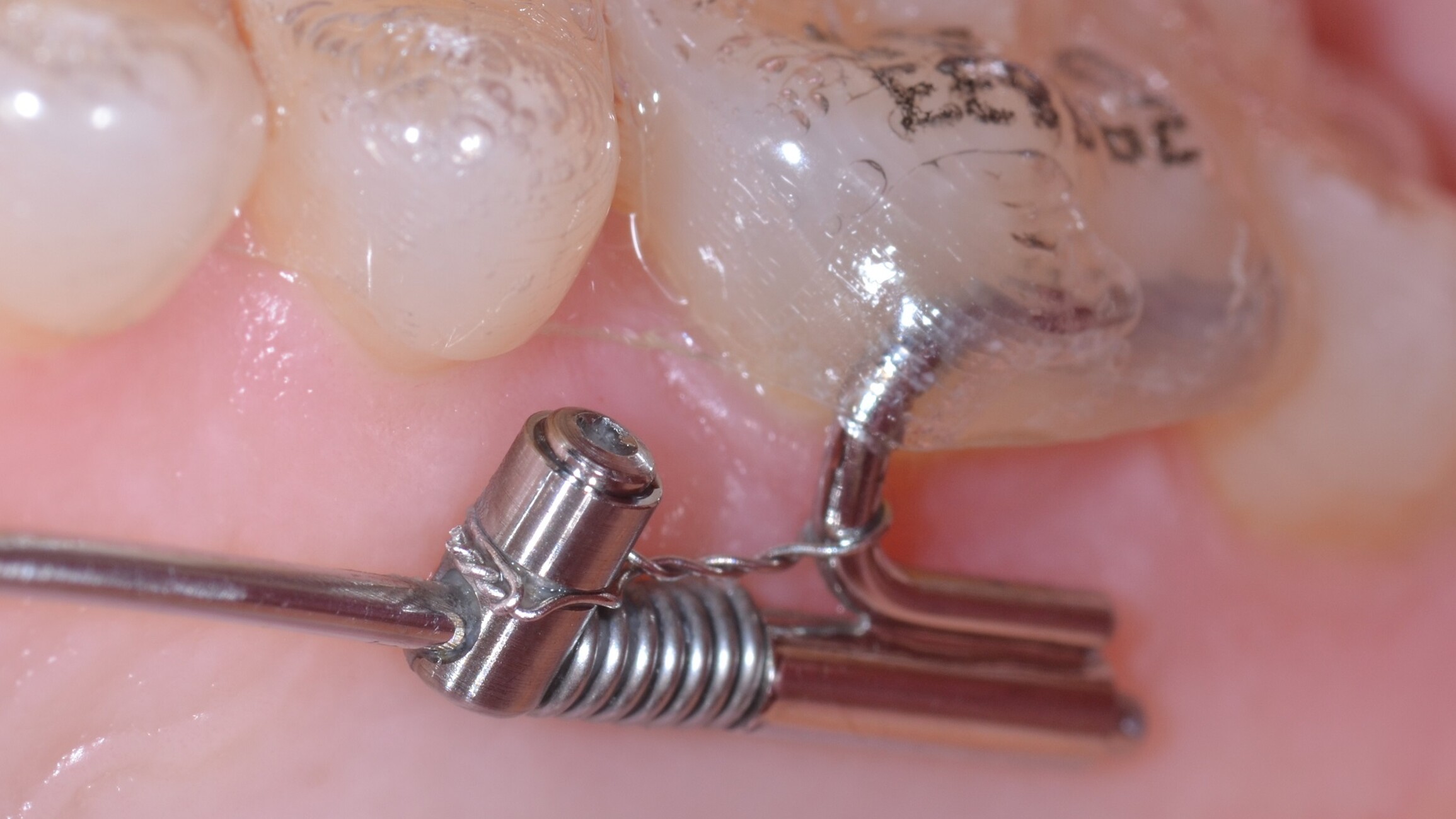 Aligner therapy: mini-implant-borne sliders and expanders