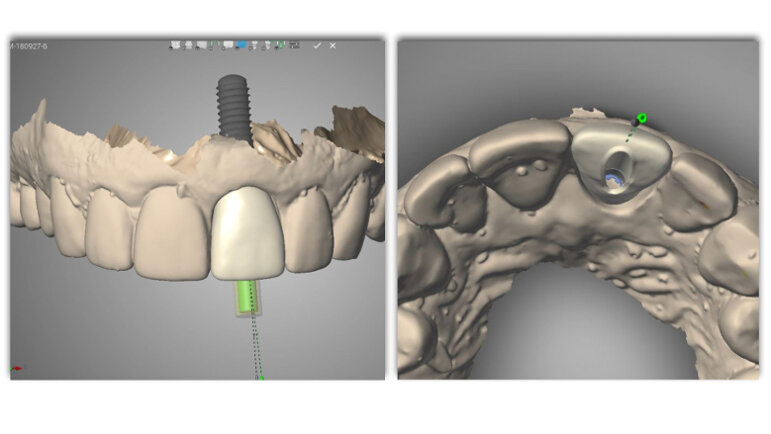 Three steps to enhance your dental implant laboratory