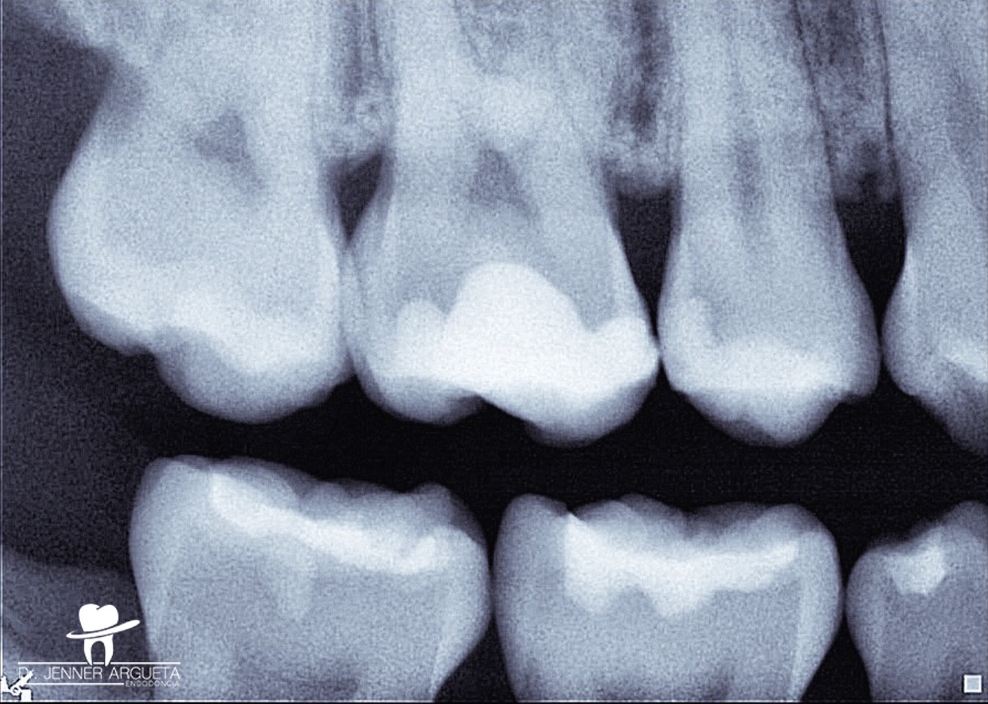 Endodontics: vital pulp therapy