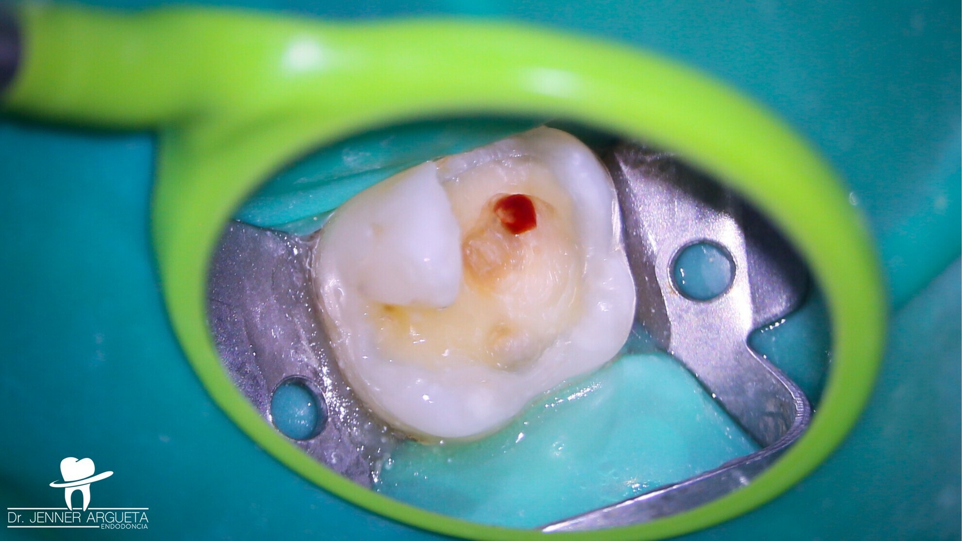 Endodontics: vital pulp therapy