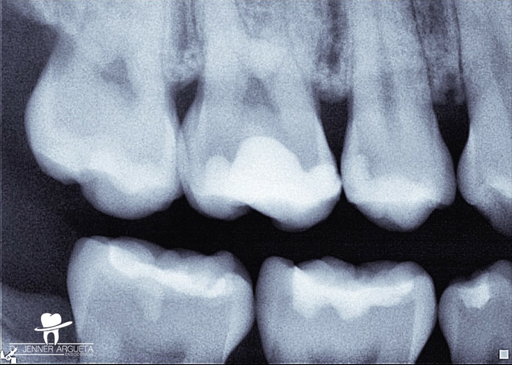 Endodontics: vital pulp therapy