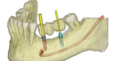 SimPlant 2011 – Fast and easy 3D implant treatment planning