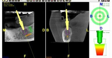 Implant Realtime Imaging System (IRIS-100)