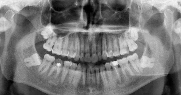 Dental News - The ProTaper technique: Shaping the future of endodontics