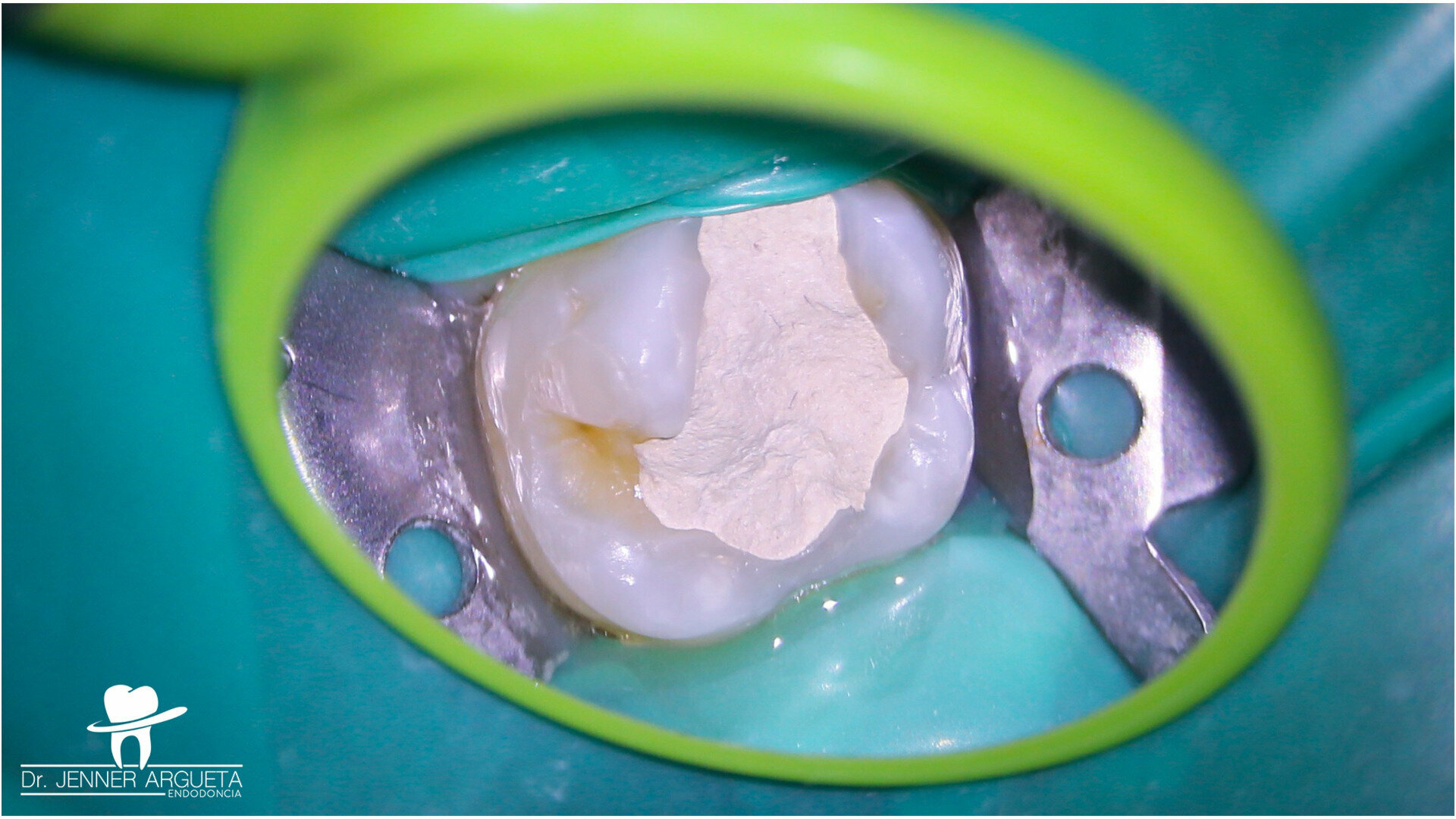 Endodontics: vital pulp therapy