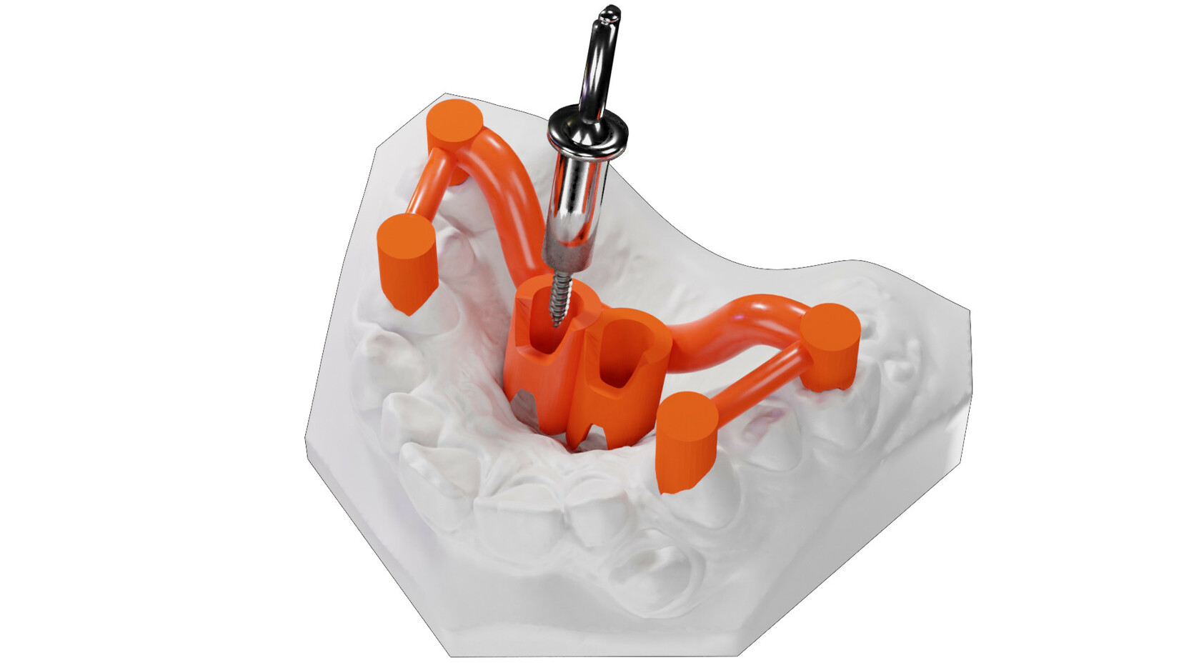 Aligner therapy: mini-implant-borne sliders and expanders