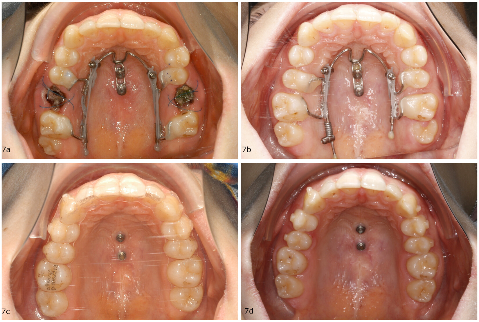 Aligner therapy: mini-implant-borne sliders and expanders