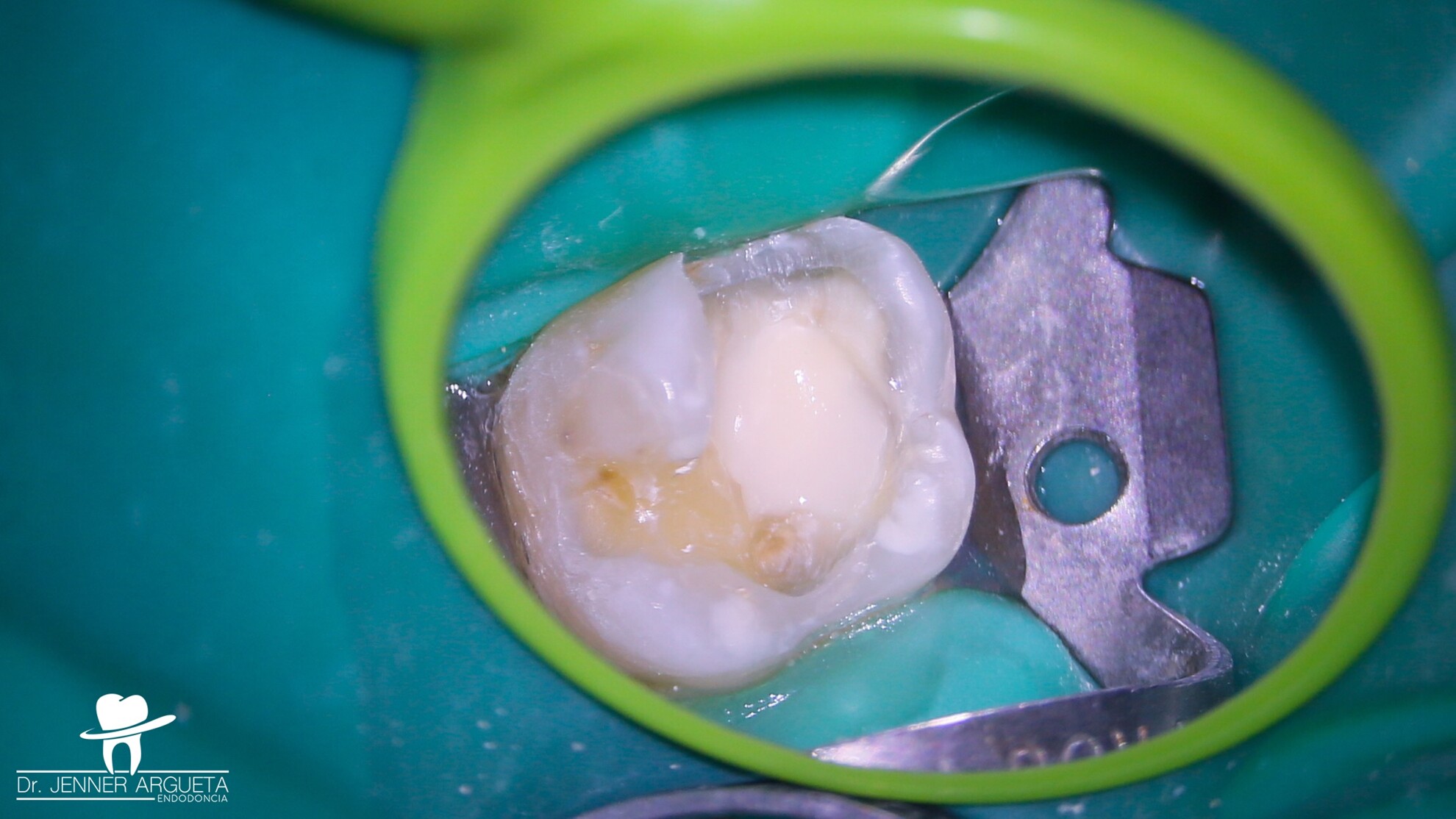 Endodontics: vital pulp therapy