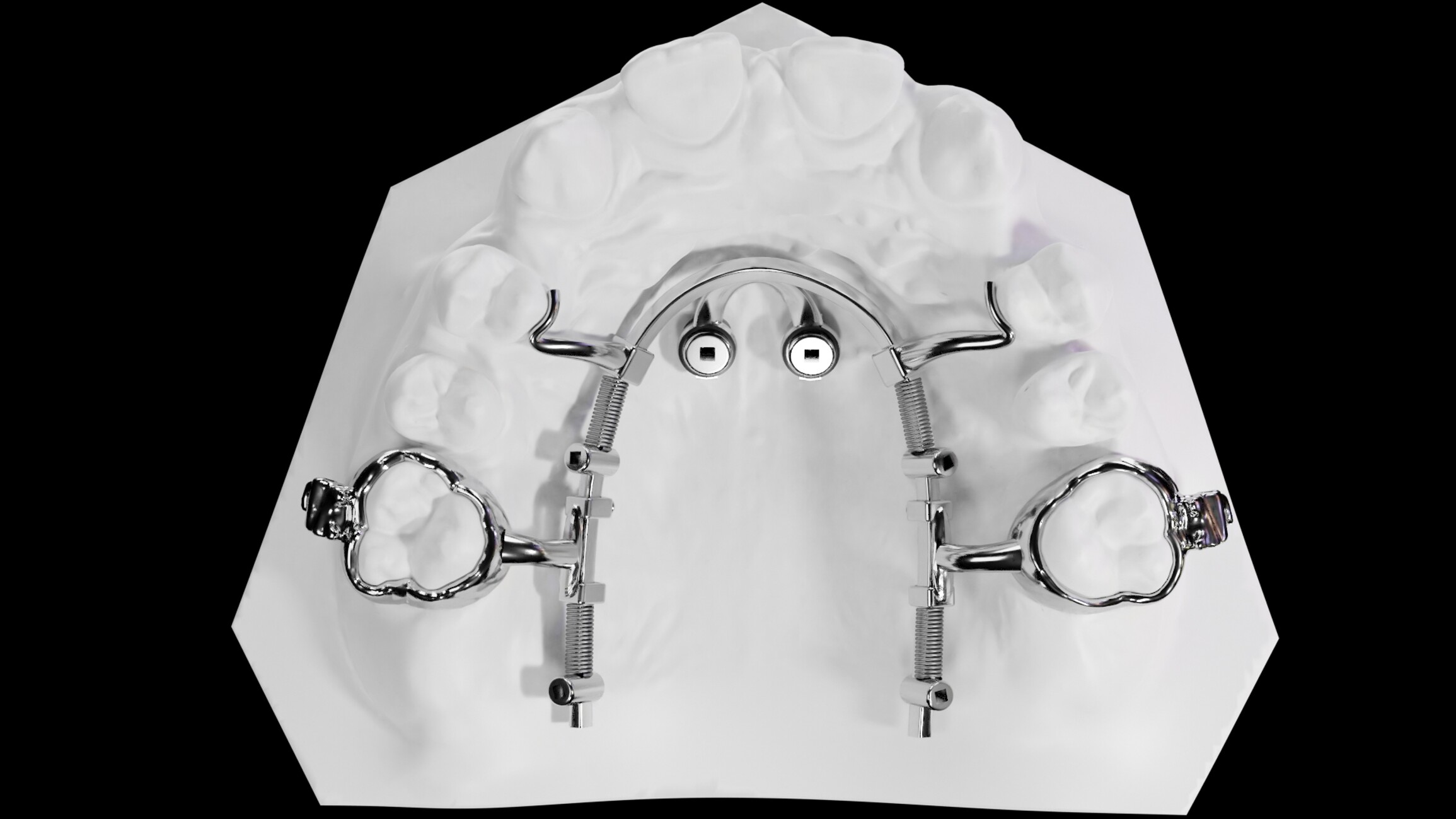 Aligner therapy: mini-implant-borne sliders and expanders